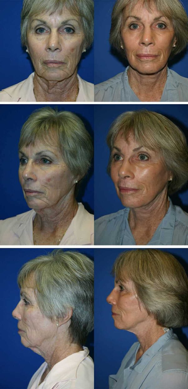 Face/Neck Lift Before & After | Fort Myers & Naples, FL | Dr. Stevens